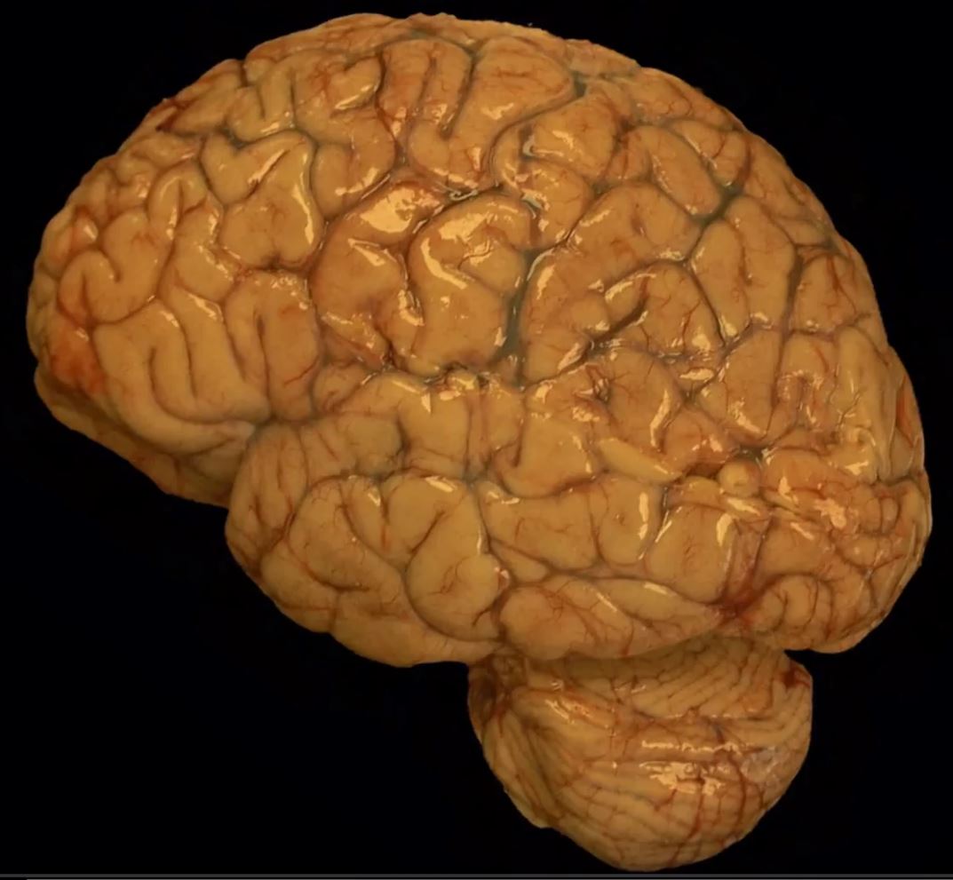 Video: Language Centers of the Brain – Adventures in Neuropathology