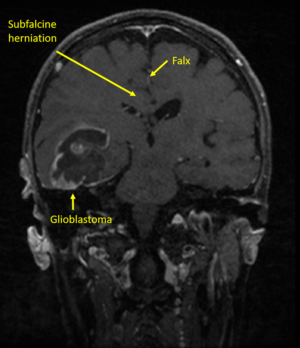 Subfalcine Herniation