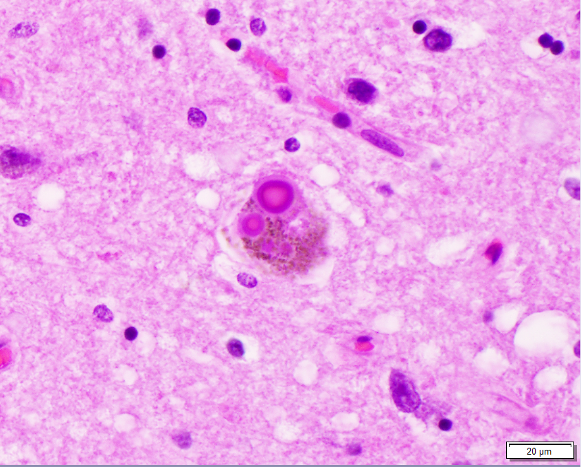 Lewy Body – Adventures in Neuropathology