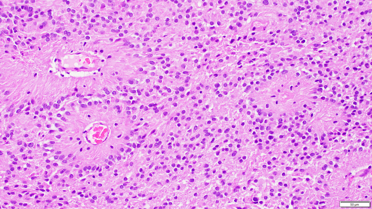 Perivascular pseudo-rosettes in Ependymoma – Adventures in Neuropathology
