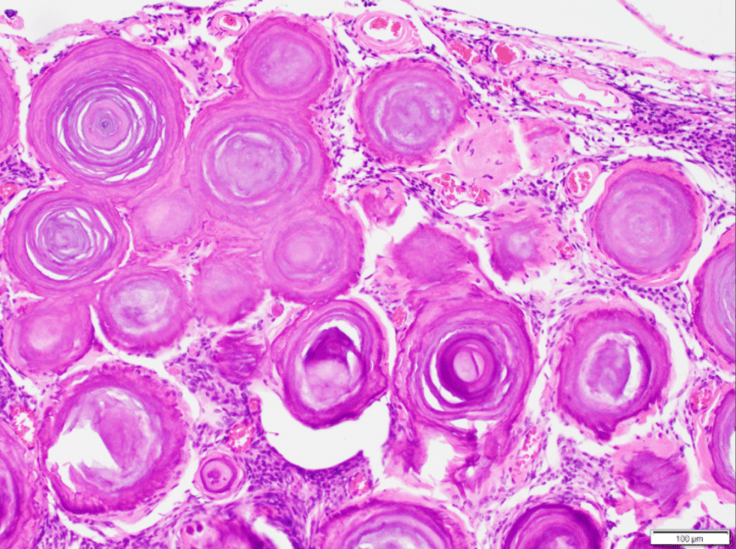 Psammoma bodies in a psammomatous variant of meningioma. – Adventures ...