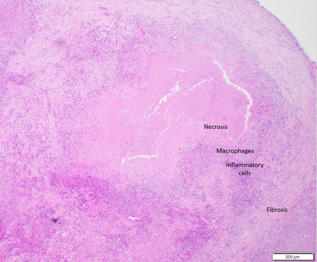 Caseous Necrosis Histology Tuberculosis, Renal