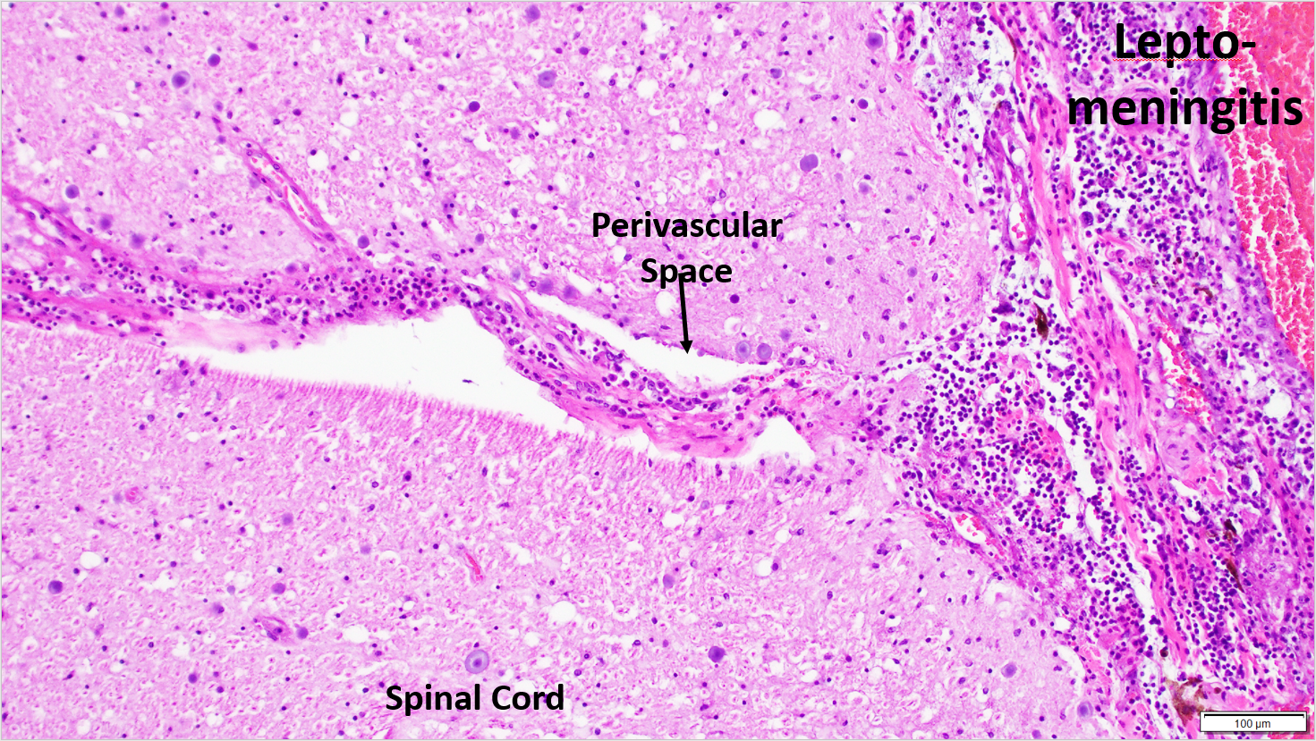 Leptomeningitis and Perivascular Spread – Adventures in Neuropathology