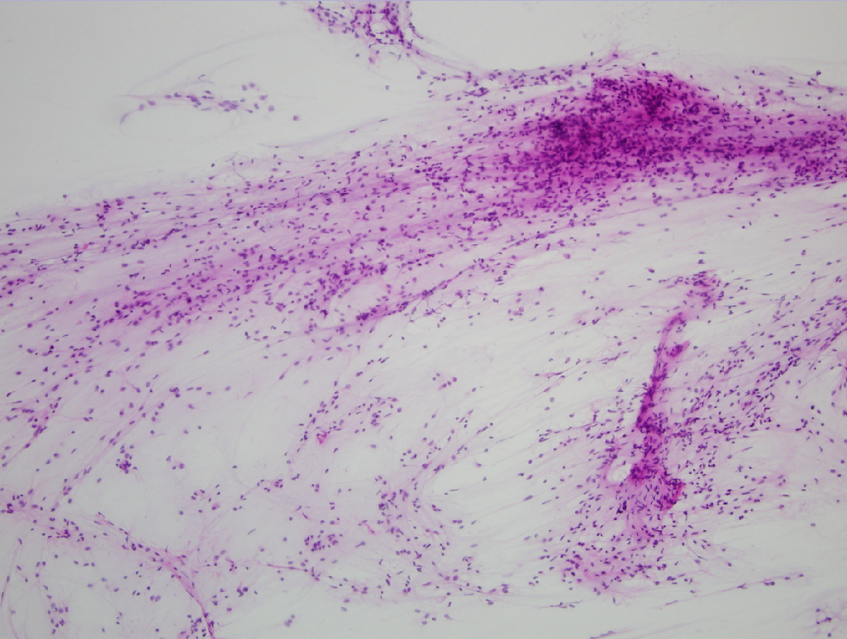 Pilocytic Astrocytoma Cytology – Adventures in Neuropathology