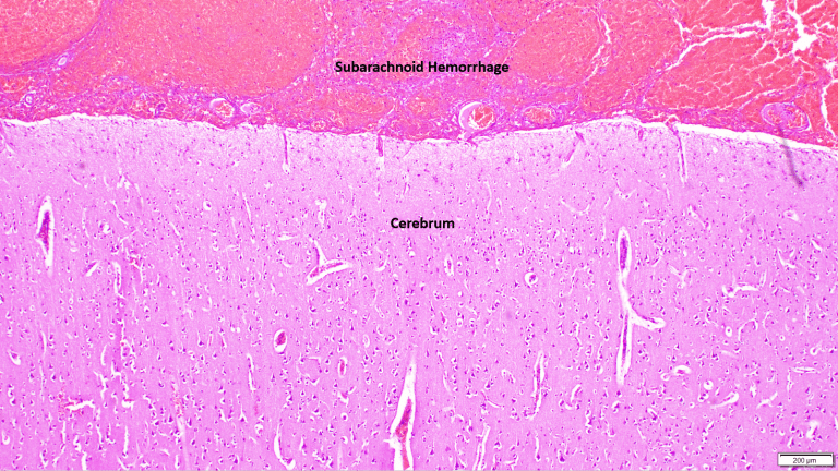 Subarachnoid Hemorrhage – Adventures in Neuropathology