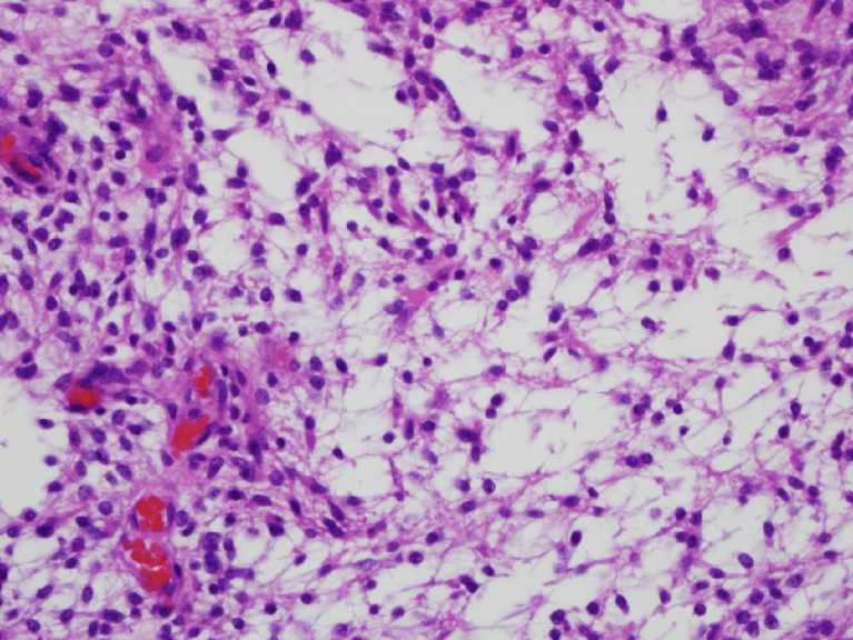 Pilocytic Astrocytoma – Molecular testing to aid histologic diagnosis ...