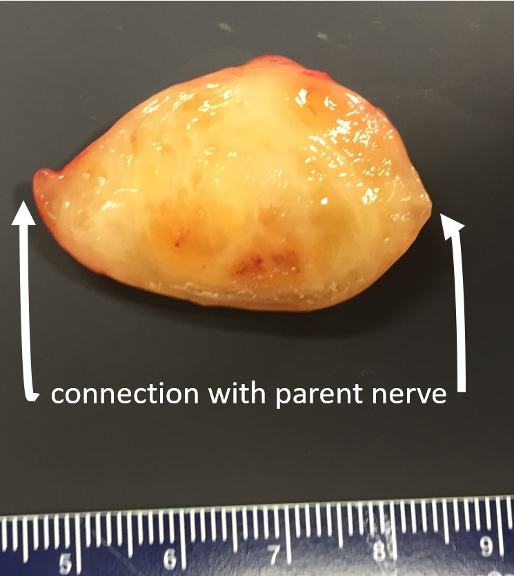 Schwannoma Gross Appearance – Adventures in Neuropathology