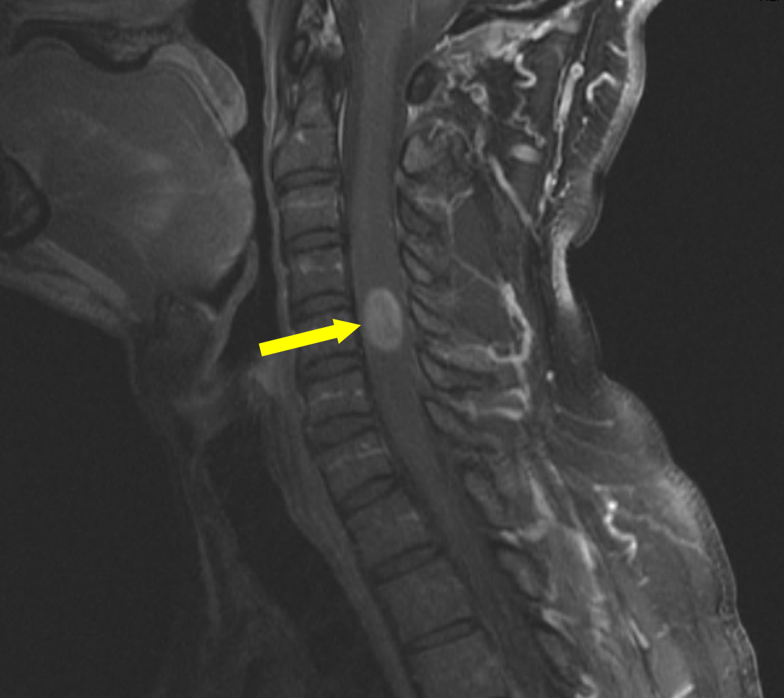 Spinal Ependymoma: Typical Radiographic Appearance – Adventures in ...