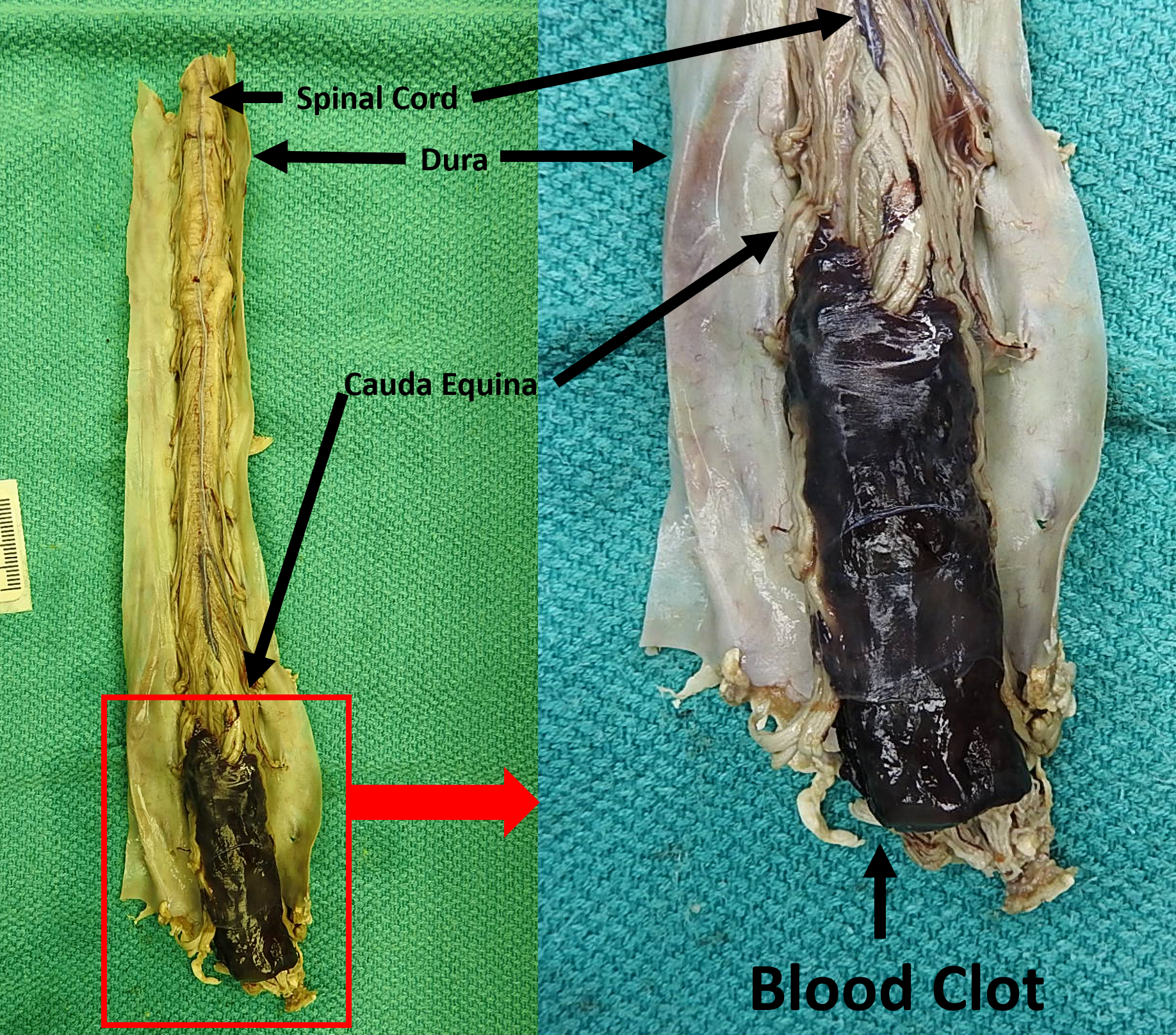 Spinal Hematoma Associated with Lumbar Puncture – Adventures in ...