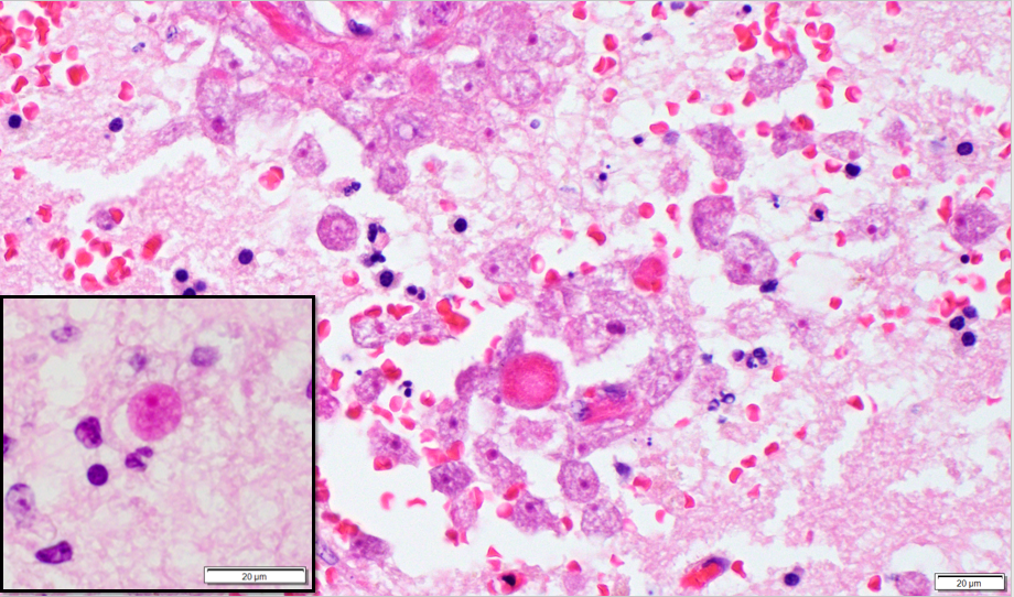 Brain Eating Amoeba – Adventures in Neuropathology