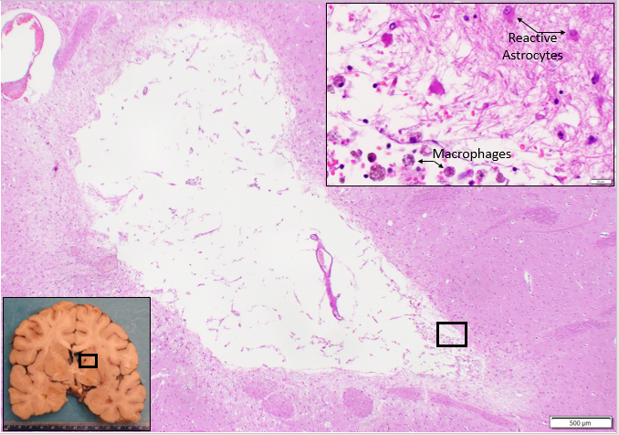 Lacunar Infarction of Basal Ganglia – Adventures in Neuropathology