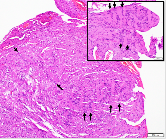 Verocay Bodies in Schwannoma – Adventures in Neuropathology