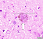 Globose Neurofibrillary Tangle – Adventures in Neuropathology
