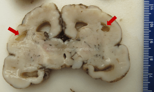 Periventricular Leukomalacia (PVL) – Adventures in Neuropathology