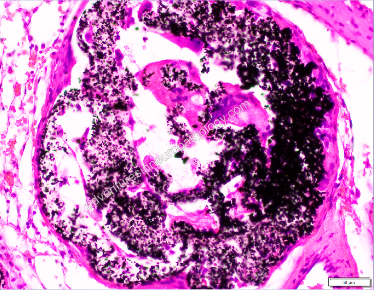 Resorption of Embolic Material in Arteriovenous Malformation (AVM ...