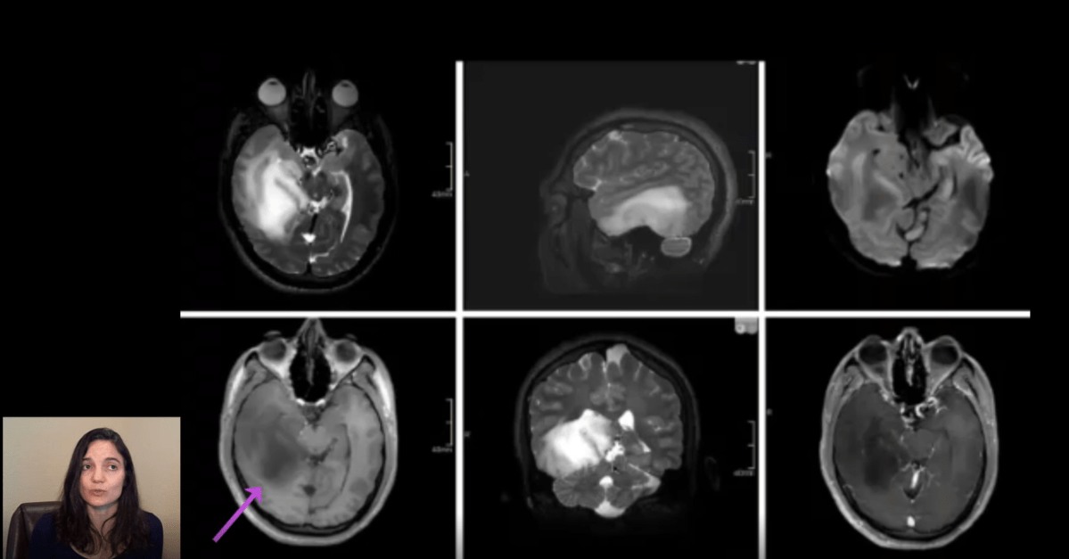 Video: IDH – Mutant Astrocytoma: Update from the 5th Edition WHO ...